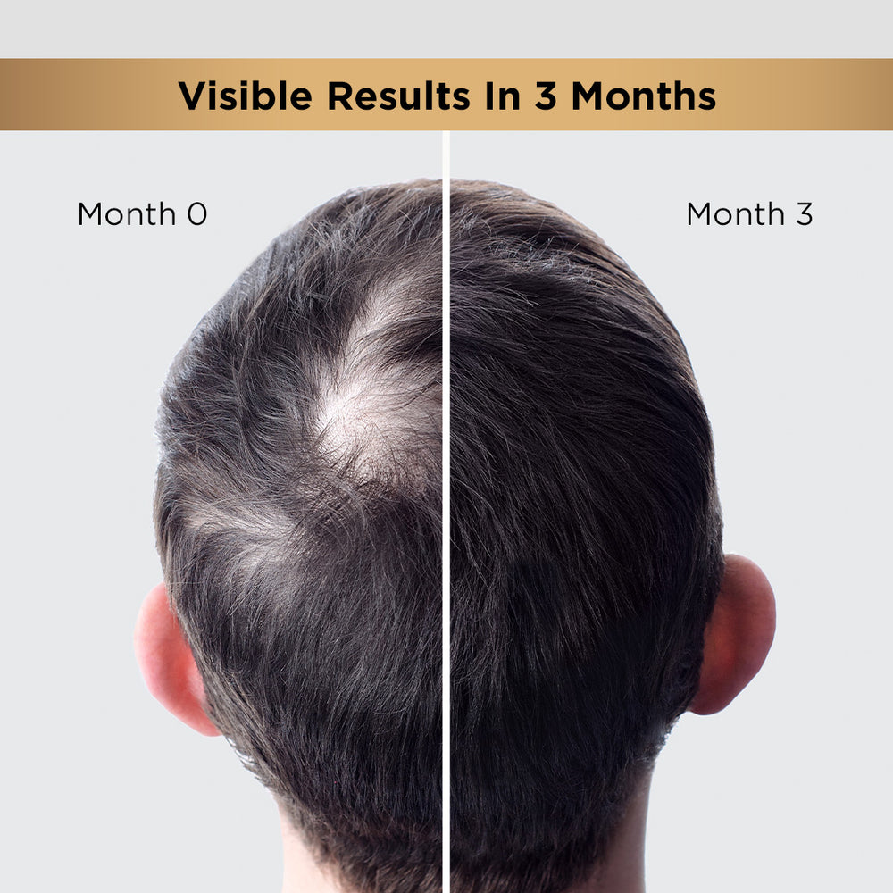 Best Men's Hair Oil | Onion Hair Oil - Hair Growth Oil For Men | The ...