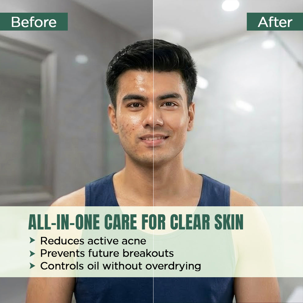 Buy Anti-Acne Face Wash for Acne Treatment – The Man Company